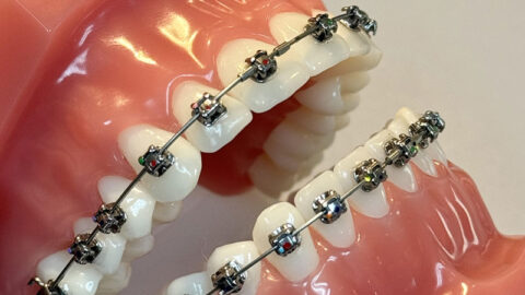 The Damon Ultima Bracket System - Next Generation Orthodontics