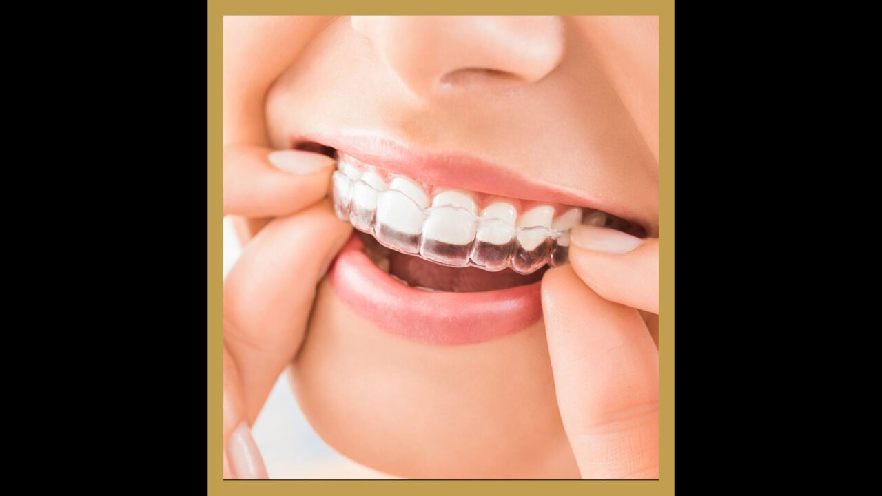 The Ultimate Guide to Braces and Clear Aligners