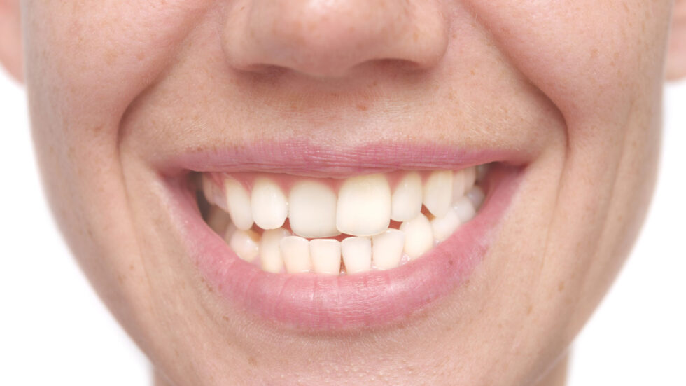 Why Are My Teeth Shifting? Understanding the Common Causes - Daia ...