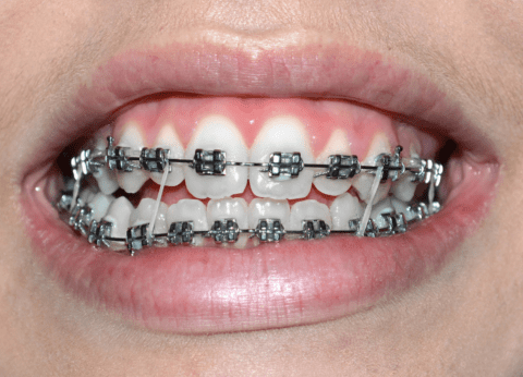 How Braces Move Teeth | Daia Orthodontics & TMJ Orthopedics ...
